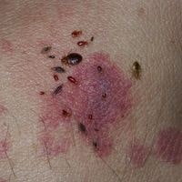 Speck Tiny Black Bugs On Skin (How To Get Rid Of Them)